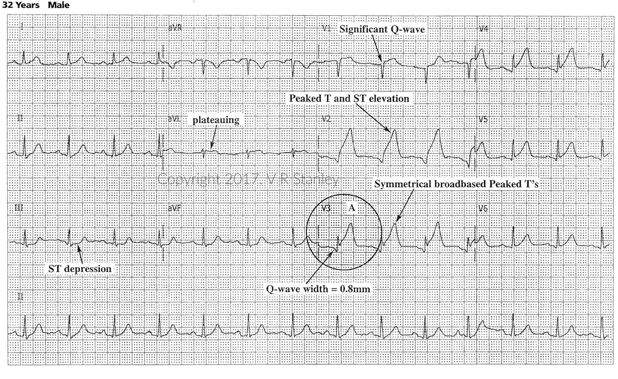 DSAE STEMI Review, Mod 3: Hyperacute T Waves - ECGcourse.com
