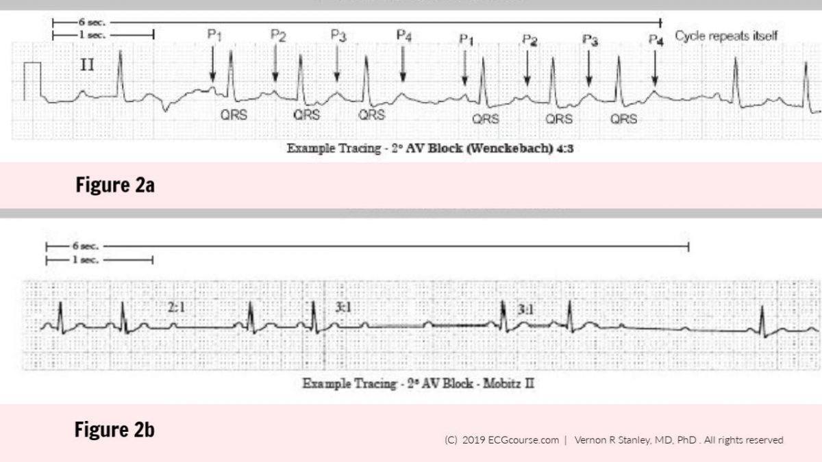 ECG Rhythms: Is this Rhythm Second Degree AV Block 2:1 Mobitz 1 (I) or ...
